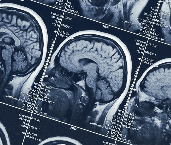 Tiny Traces of Lithium May Help Protect Brain From Alzheimer's ...