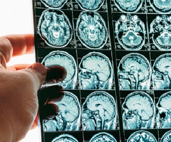 Leaky Blood-Brain Barrier to Blame for Neurodegenerative Diseases ...