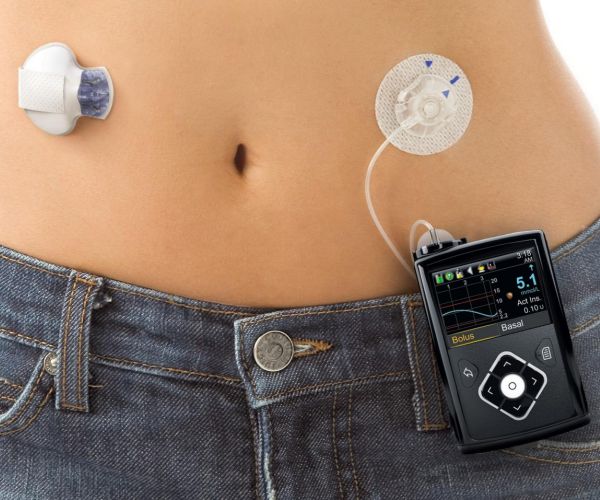 Artificial Pancreas: Diabetes Autopilot for Monitoring, Insulin ...
