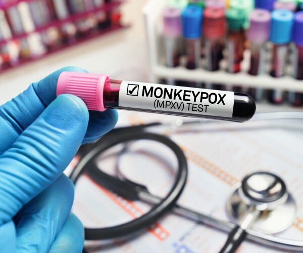 Study: Monkeypox Potentially Fatal For Those with HIV or Weak Immune ...