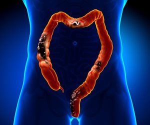 Stool Test Effective for Detecting Colon Cancer | Newsmax.com