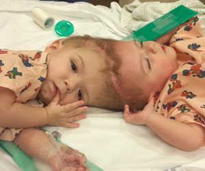 Craniopagus Conjoined Twins Joined at the Head Surgically Separated ...