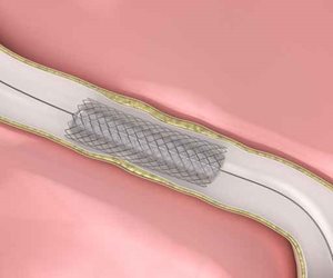 FDA Approves First Dissolving Stent for US Patients | Newsmax.com