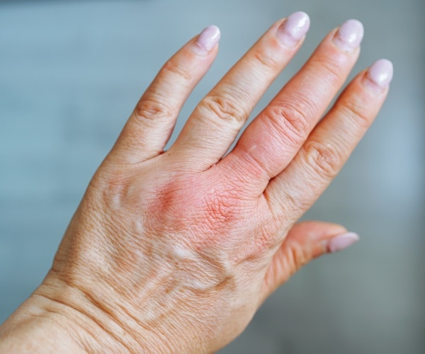 What Swollen Fingers Could Mean About Your Health | Newsmax.com