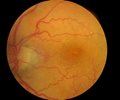 Implant for Chronic Eye Disorder Wins FDA Approval | Newsmax.com