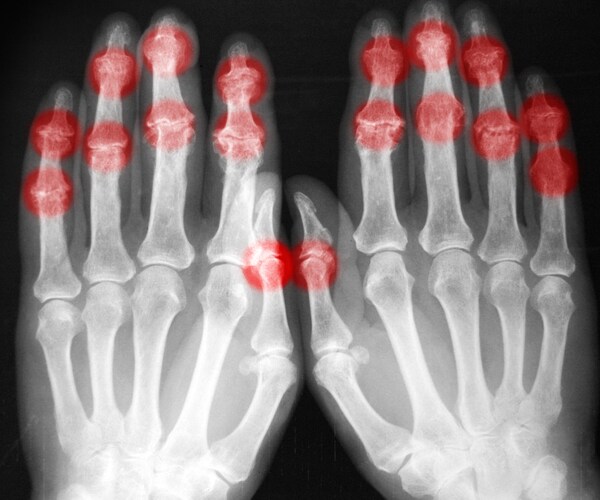 High Cholesterol May Trigger Arthritis | Newsmax.com